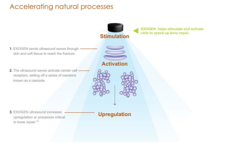 exogen how it works - Advanced Foot And Ankle Center Of San Diego