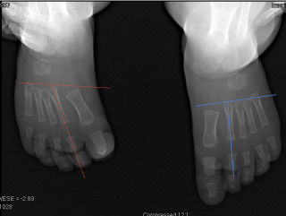 metadductus x ray 2 - Advanced Foot And Ankle Center Of San Diego