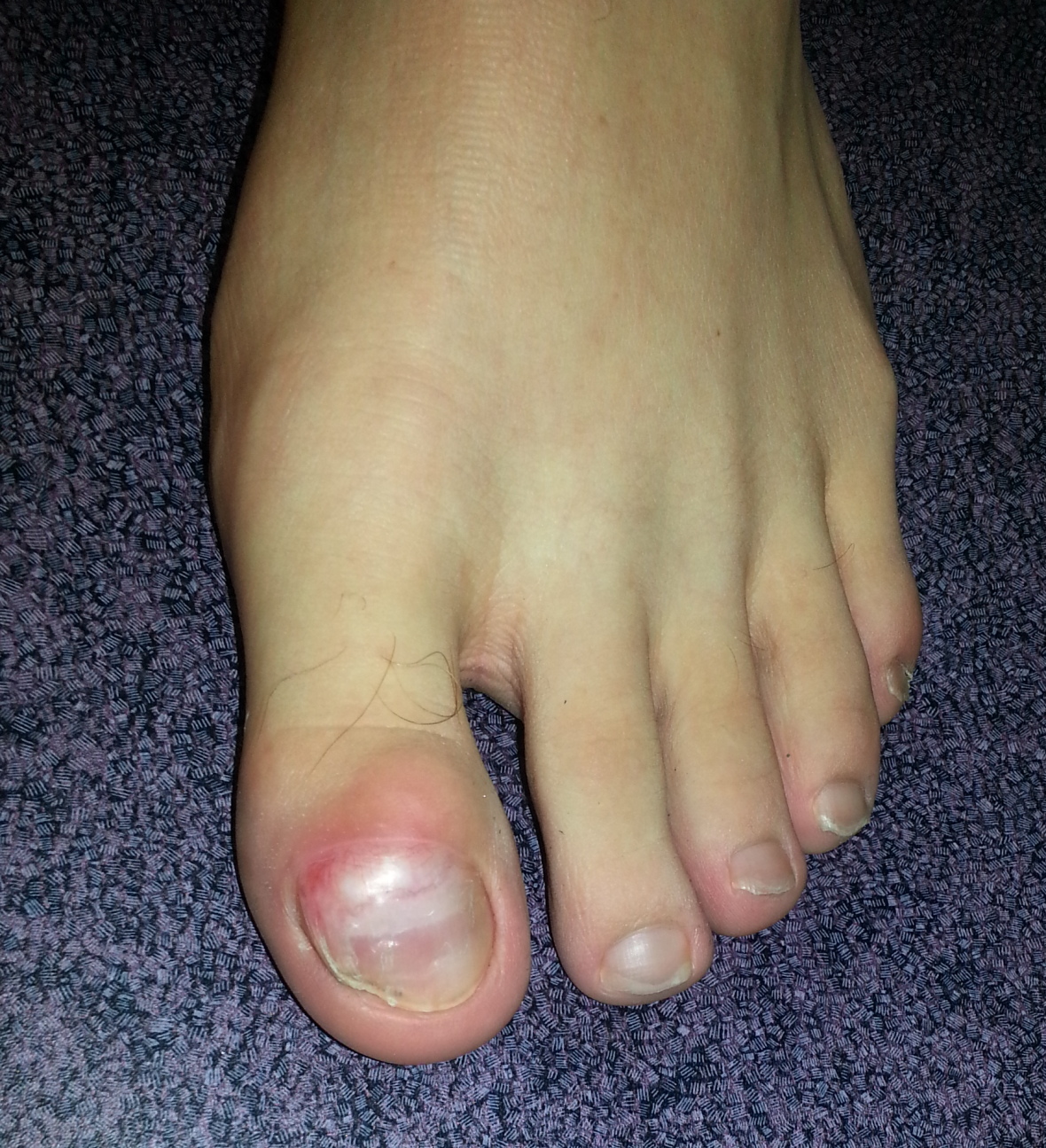 Ingrown Toenails - Advanced Foot And Ankle Center Of San Diego