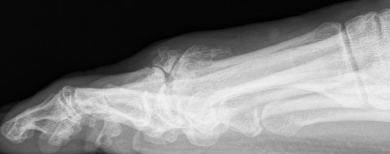 Hallux rigidus with fracture - Advanced Foot And Ankle Center Of San Diego