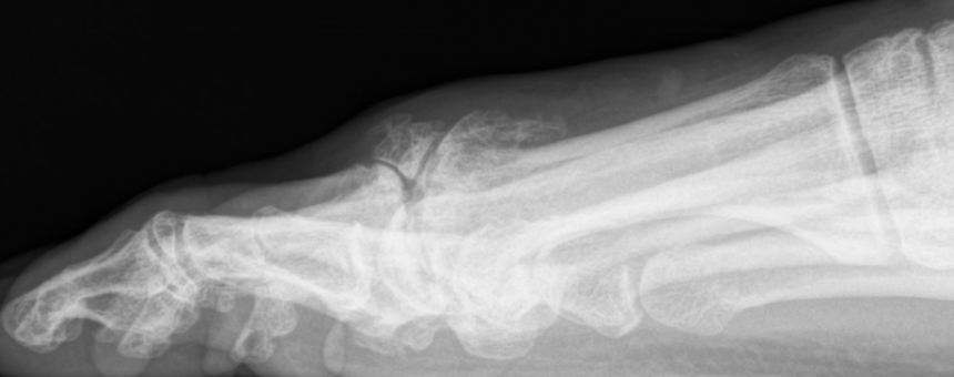 Hallux rigidus with fracture - Advanced Foot And Ankle Center Of San Diego