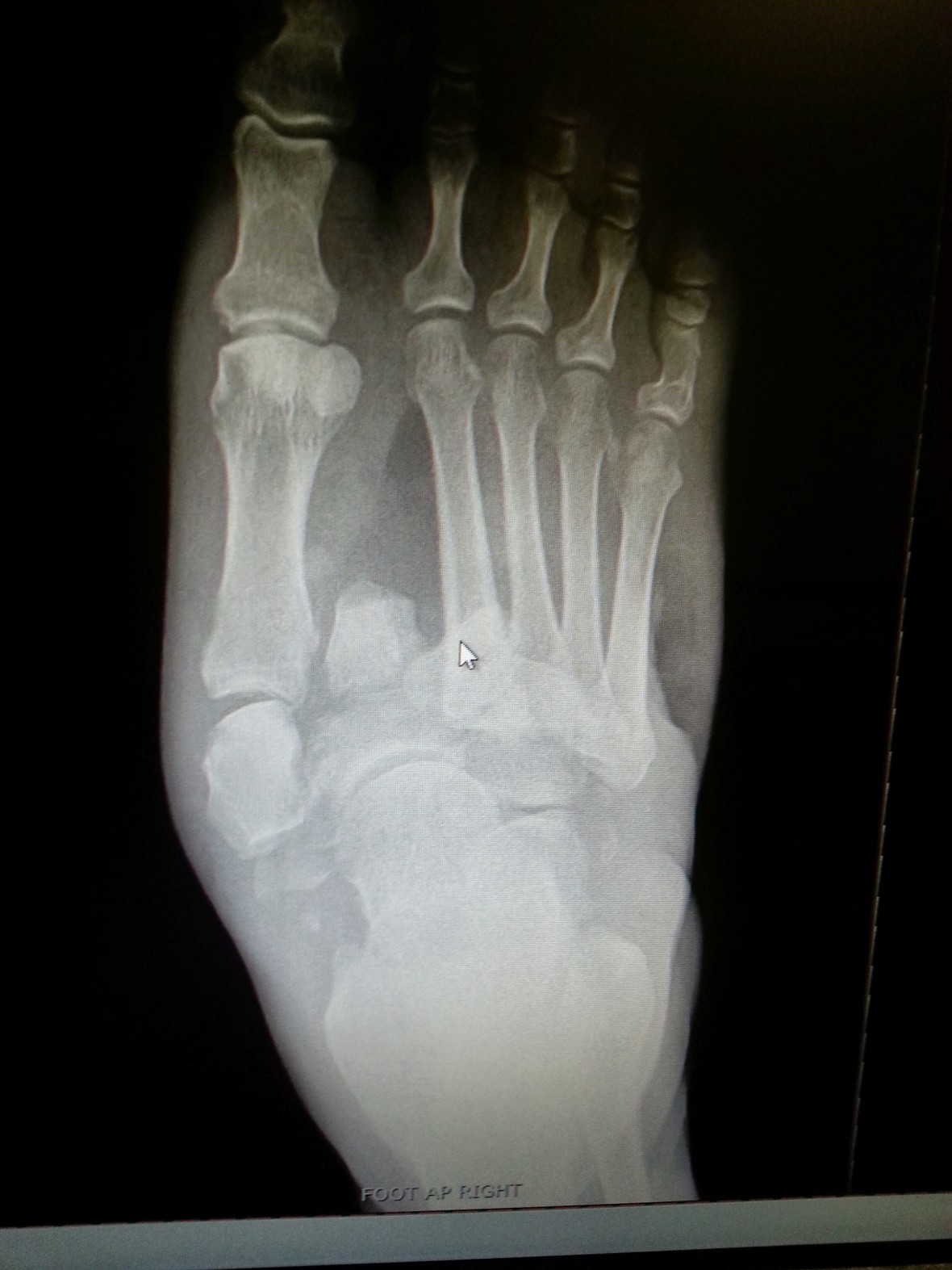 Diabetic Charcot Foot repair - Advanced Foot And Ankle Center Of San Diego