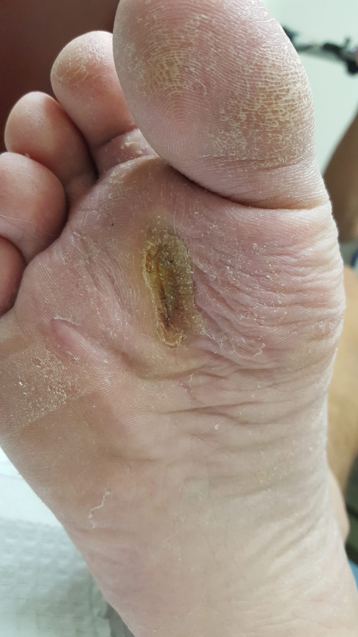 Charcot foot ulcer - Advanced Foot And Ankle Center Of San Diego