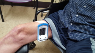 Cellutome skin graft harvesting - Advanced Foot And Ankle Center Of San ...