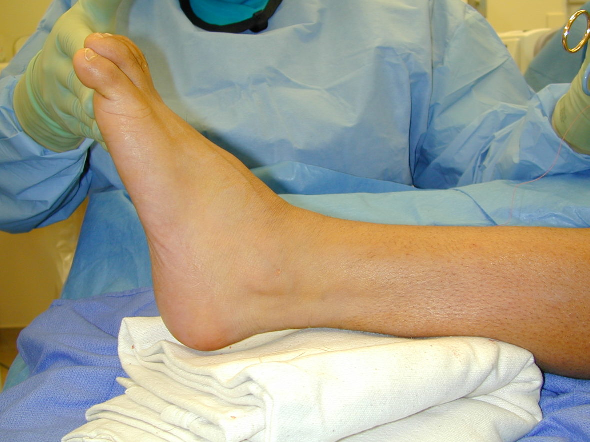 equinus ankle - Advanced Foot And Ankle Center Of San Diego
