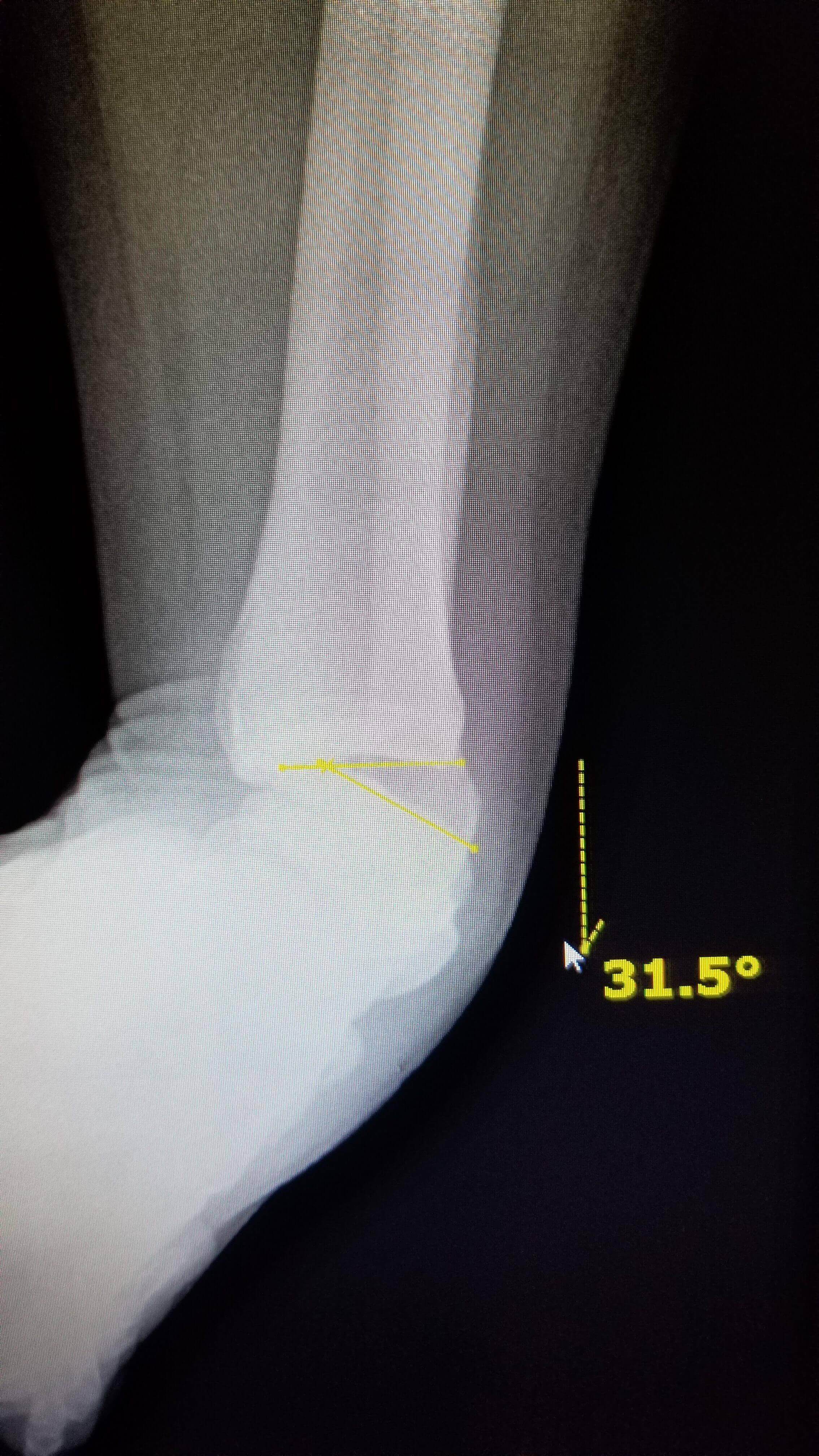 Ankle Stress inversion X ray - Advanced Foot And Ankle Center Of San Diego