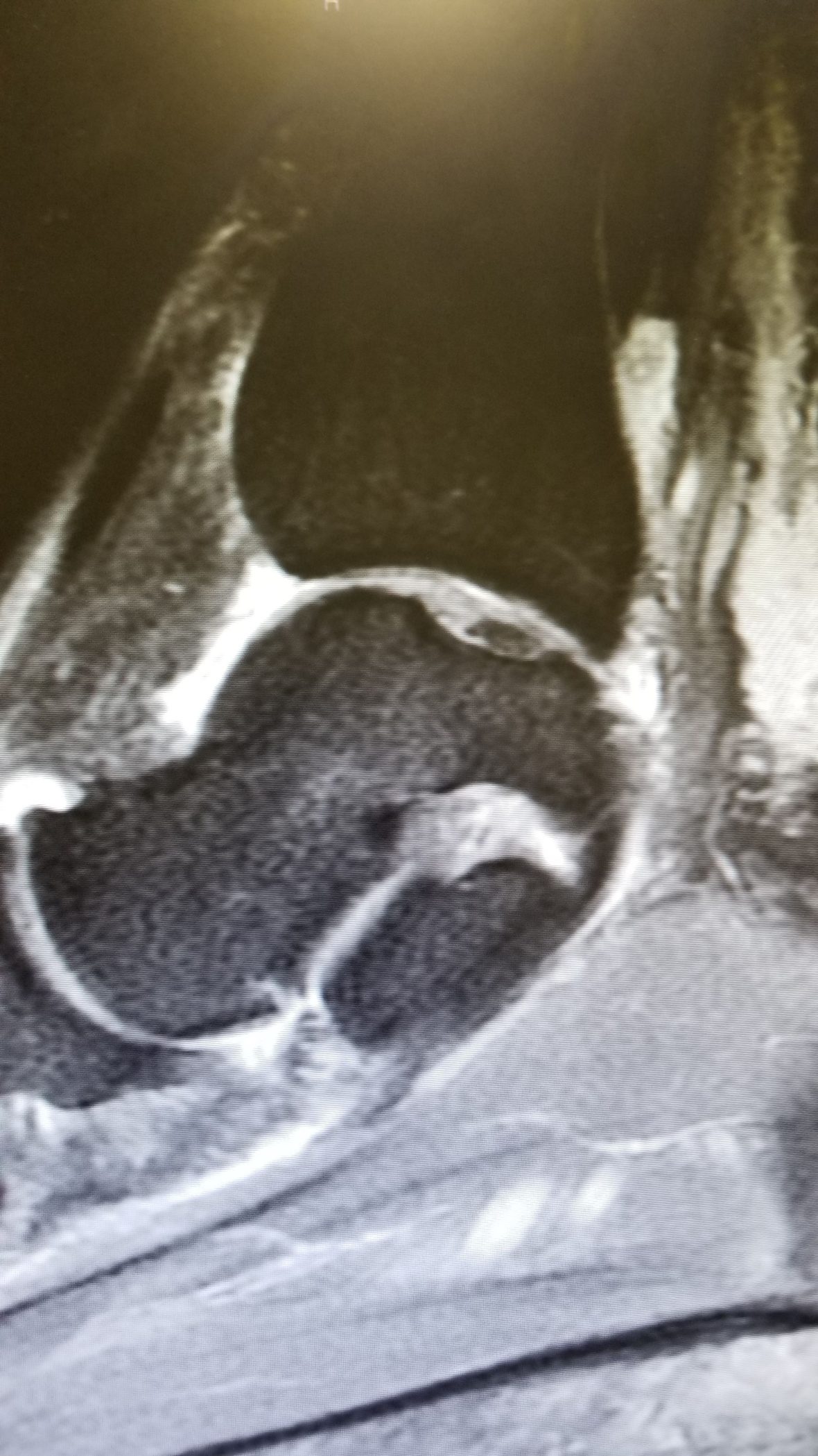 Osteochondral Defect of the Talus - Advanced Foot And Ankle Center Of ...