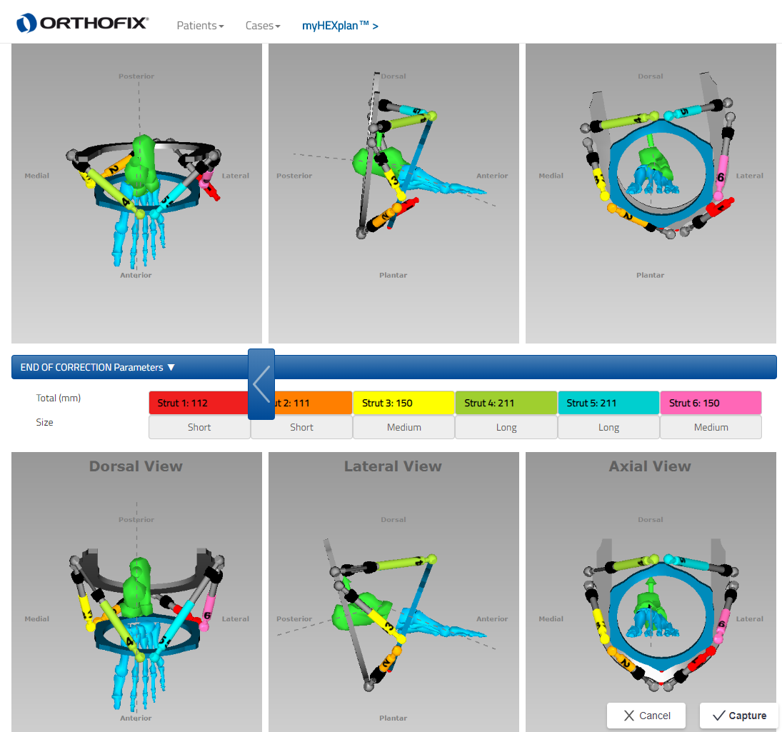 Charcot Foot And Ankle Reconstruction - Advanced Foot And Ankle Center ...