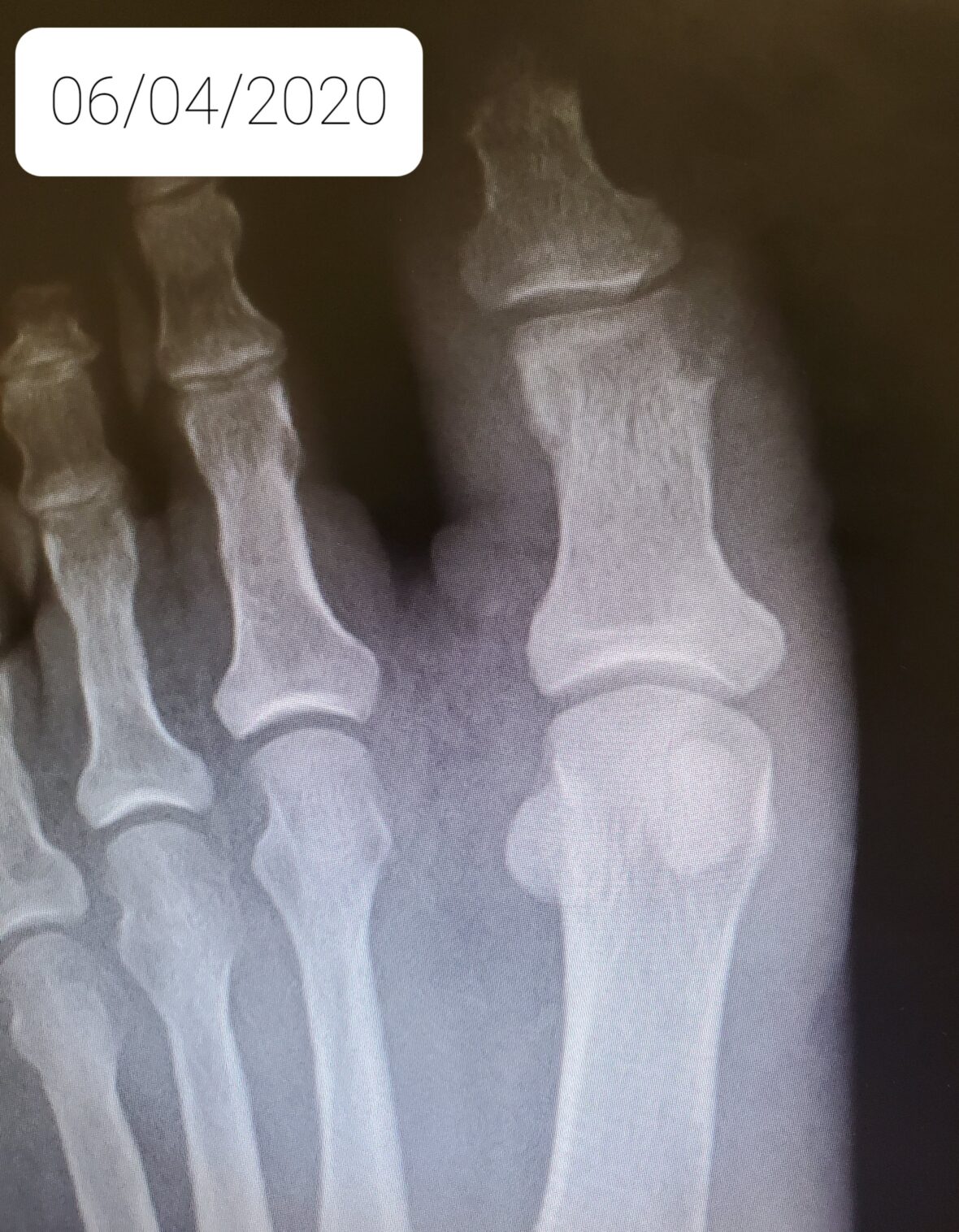 Diabetic Toe Wounds - Advanced Foot And Ankle Center Of San Diego